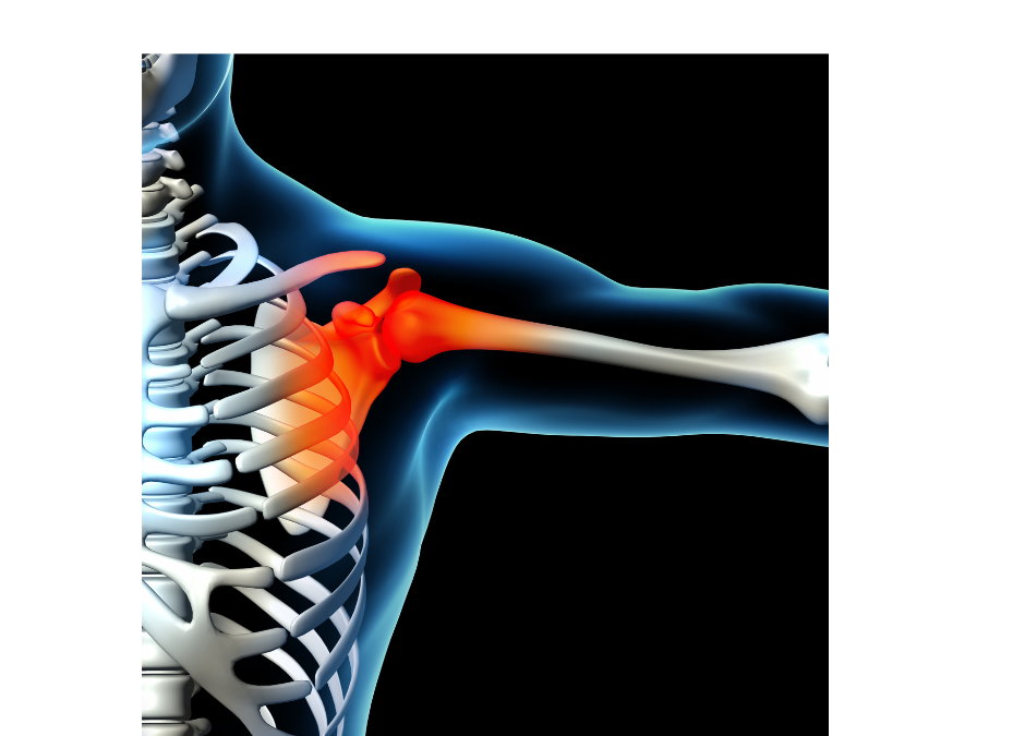 Subacromial Impingement Physio Elite